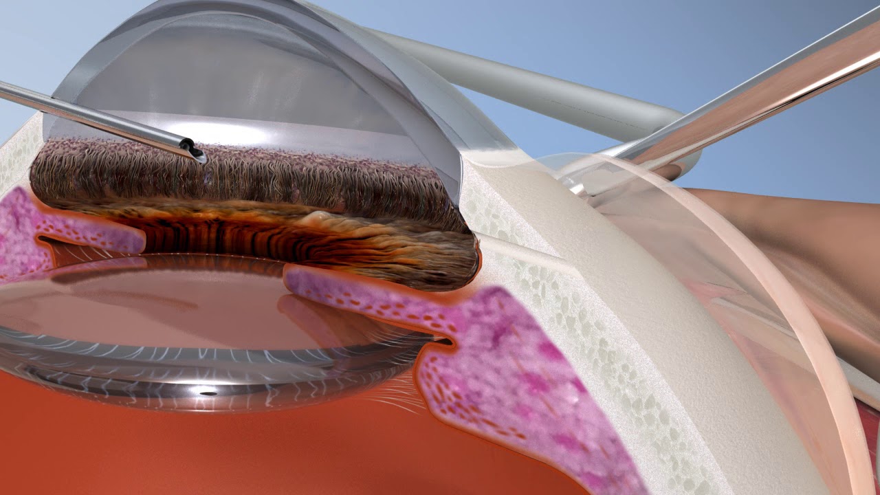 Managing Glaucoma: Exploring Surgical Treatment Options